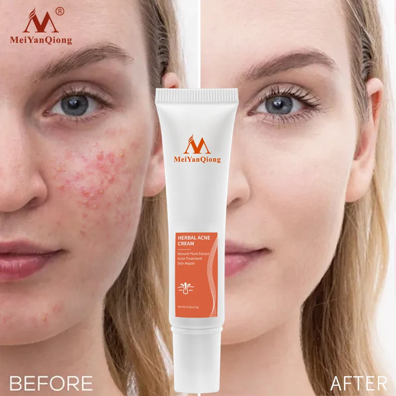 Acne-Cream-Acne-Removal-Eliminate-Acne-Marks-Repair-Damaged-Skin ...