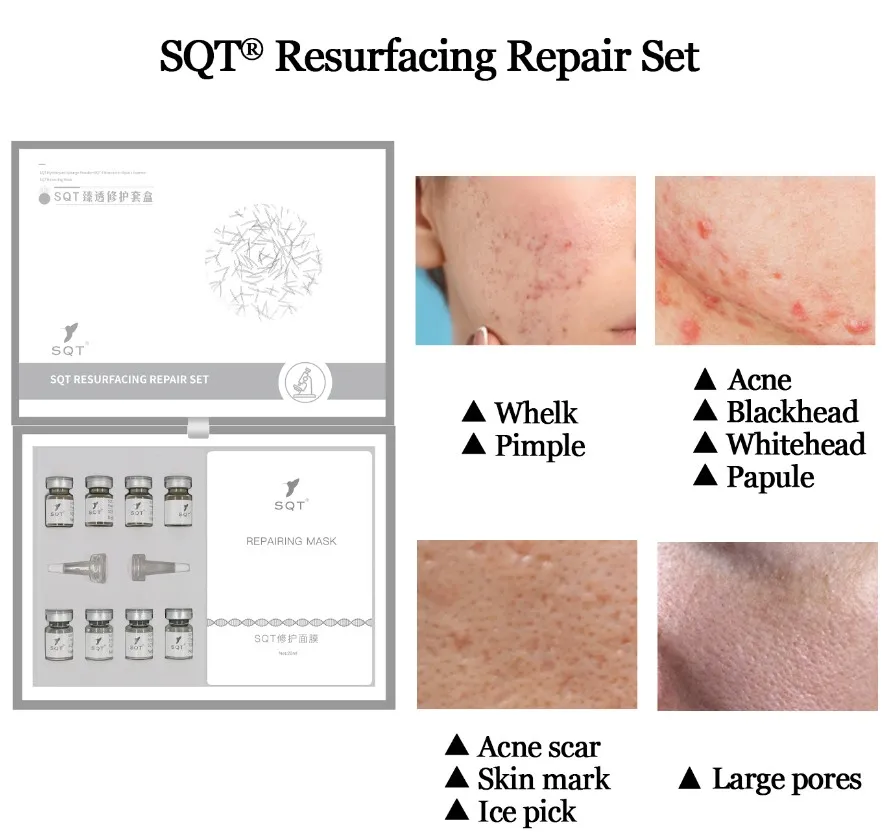 SQT resurfacing repair kit/acne peel/ facial peeling treatment ...
