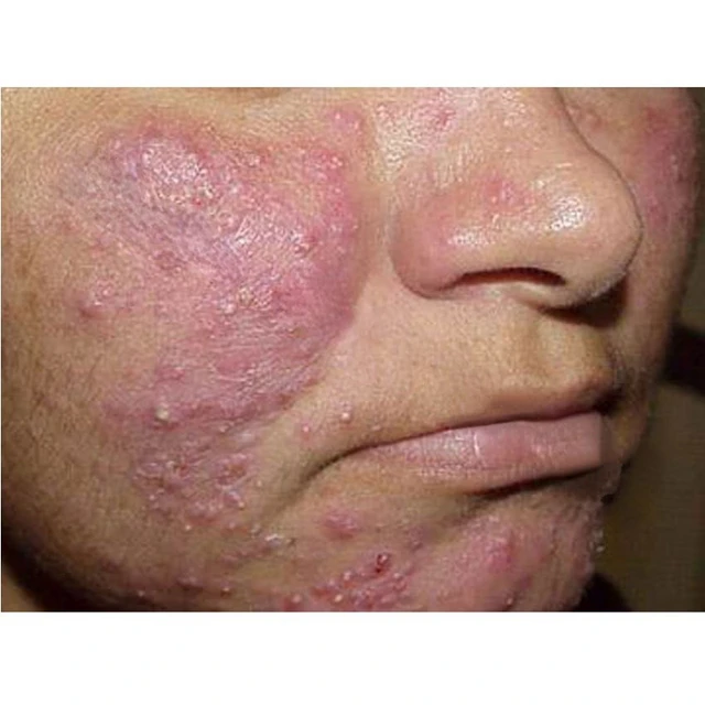 Rosacea Cream