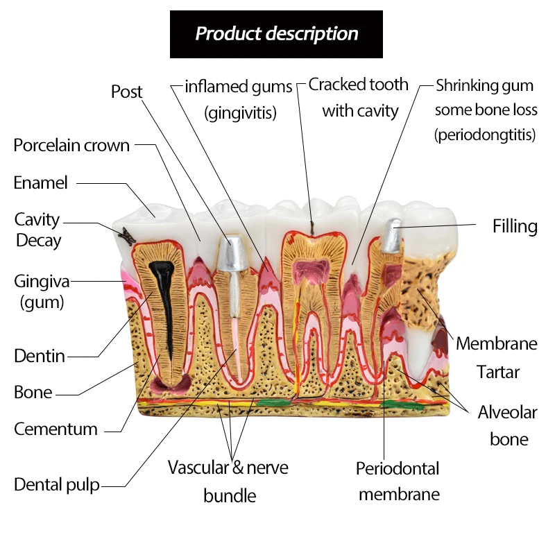Dental-Caries-Anatomy-Comprehensive-Pathology-Tooth-Nerve-Tooth-Model ...
