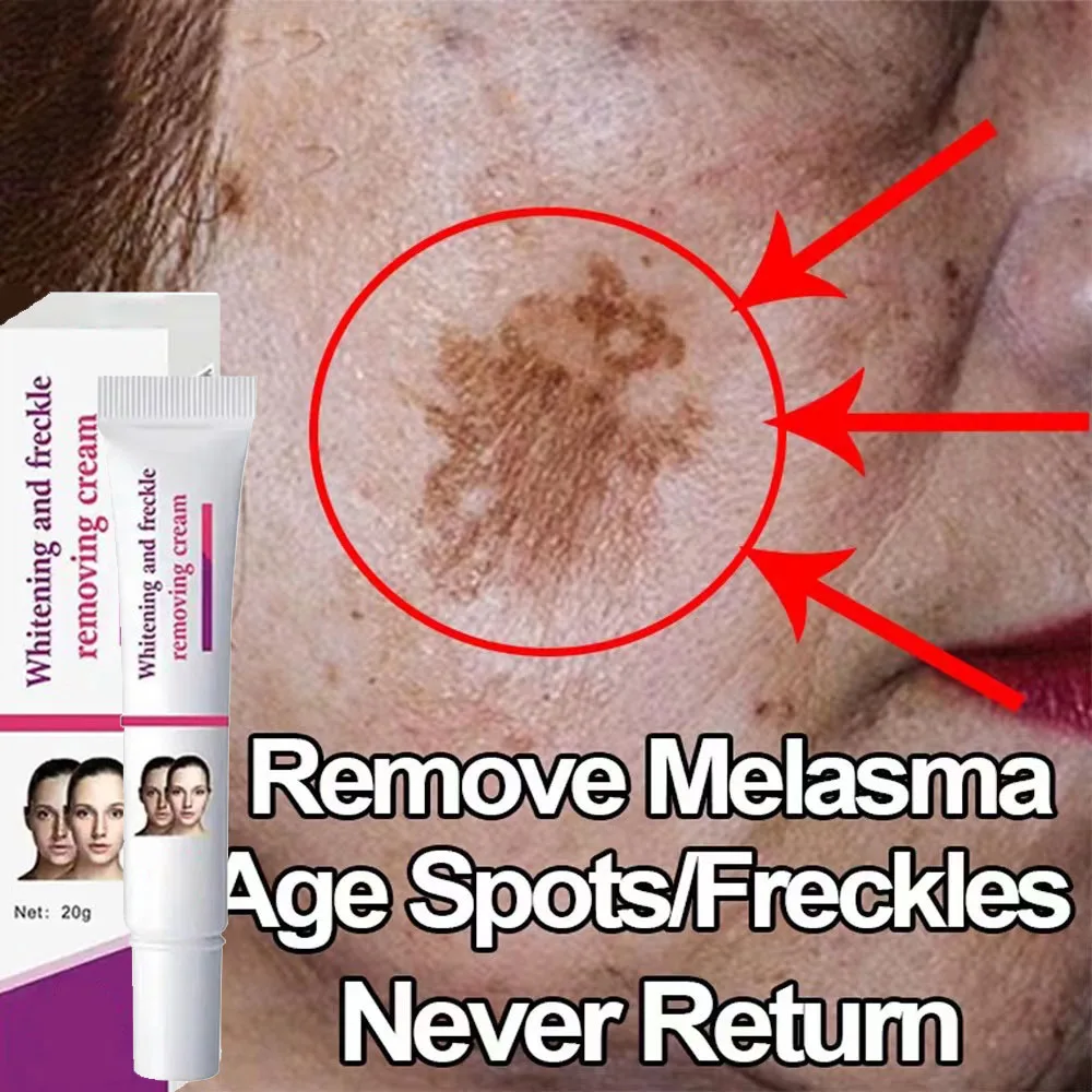 Freckles-Removal-Cream-Remove-Facial-Spots-Skin-Dark-Spot-Remove ...