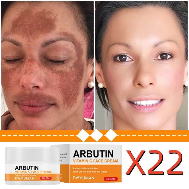 Crema-blanqueadora-y-antipecas-elimina-manchas-oscuras-chloasma-pecas ...