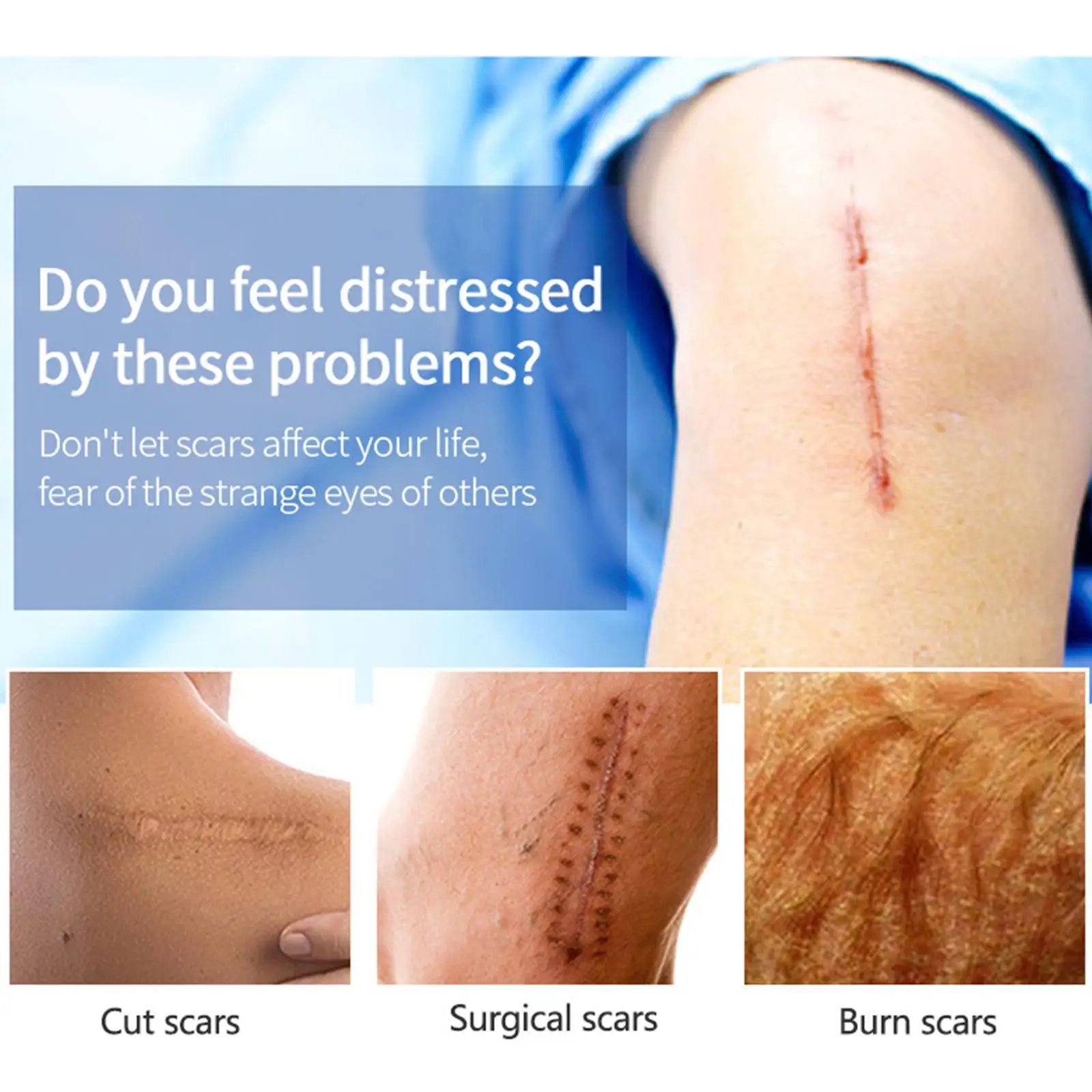 Scar-Removal-Cream-Gel-Remove-Acne-Spots-Treatment-Beauty-Burn-Scar ...