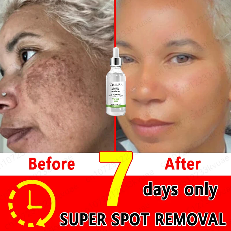 Freckles-Removal-Essence-Remove-Facial-Spots-Skin-Dark-Spot-Remove ...