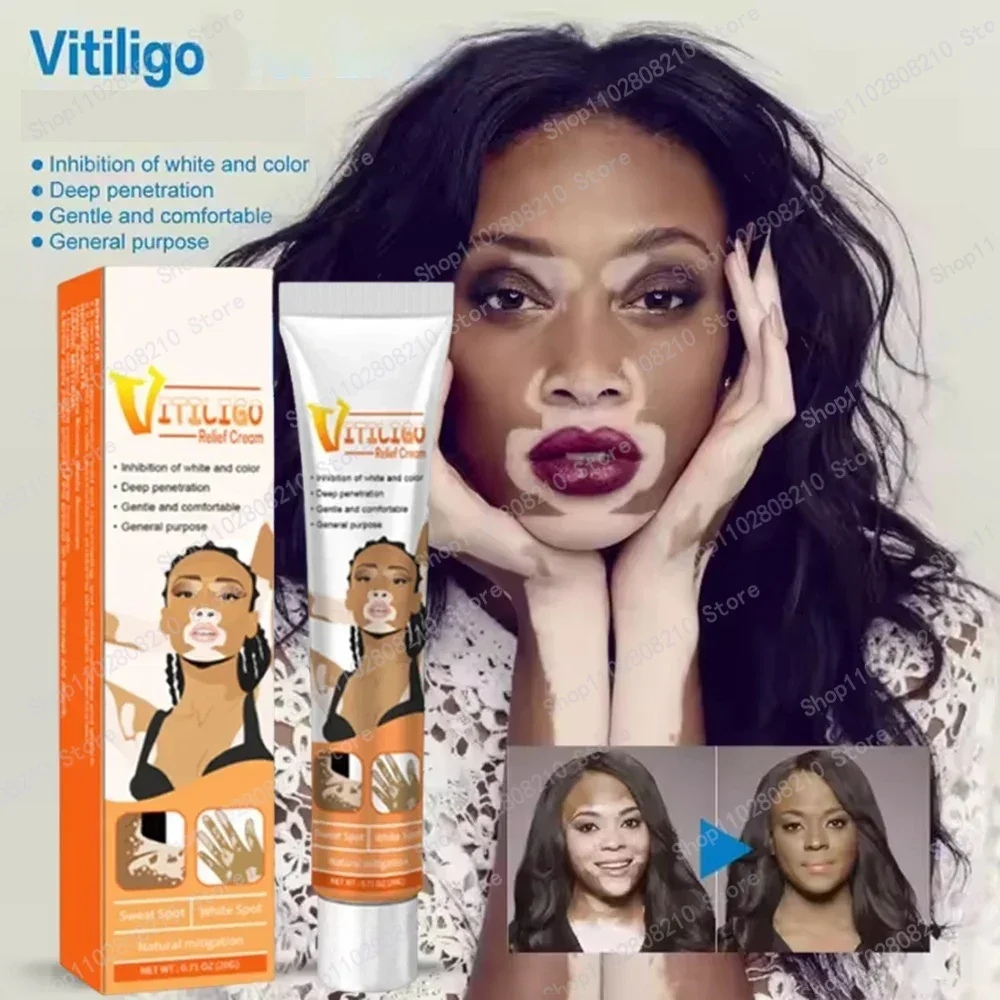 Vitiligo-Ointment-Remove-Ringworm-White-Spot-Removal-Skin-Vitiligo ...