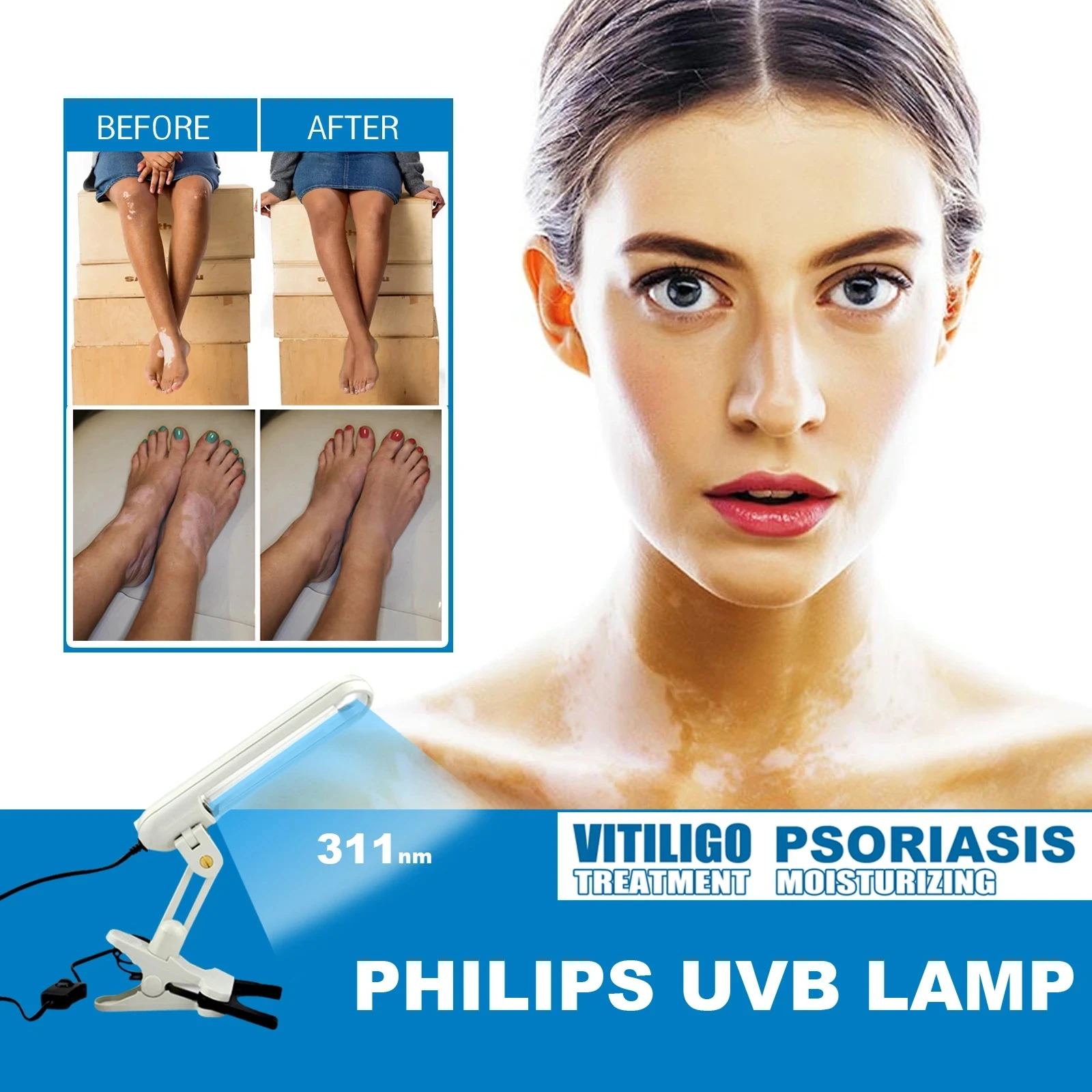 Uvb-311nm-Light-Therapy-For-Vitiligo-Psoriasis-Eczema-Dermatitis-Skin-Problems-Treatment-Uv-Lamp ...