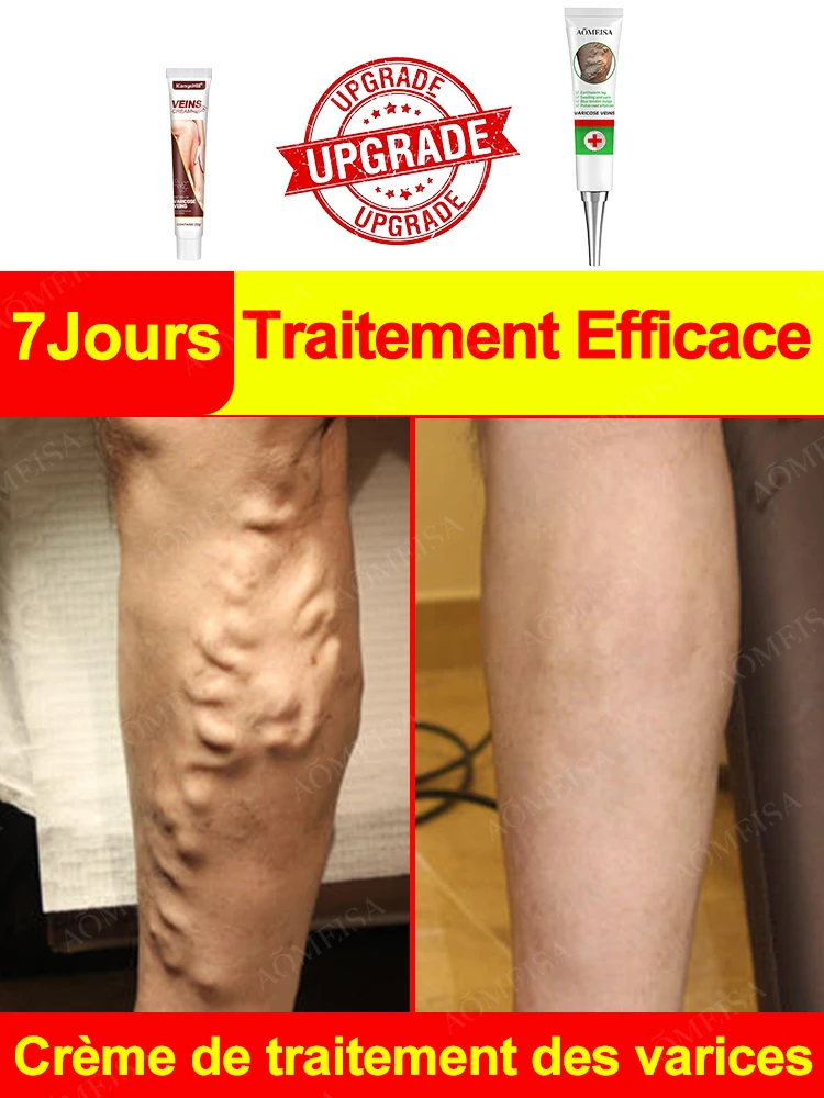 Traitement Des Varices : Lequel Choisir Pour Les Faire Disparaître – PCETSK