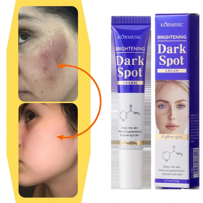 Does This Acne Mark Dark Spot Removal Cream Actually Work? Real Results ...