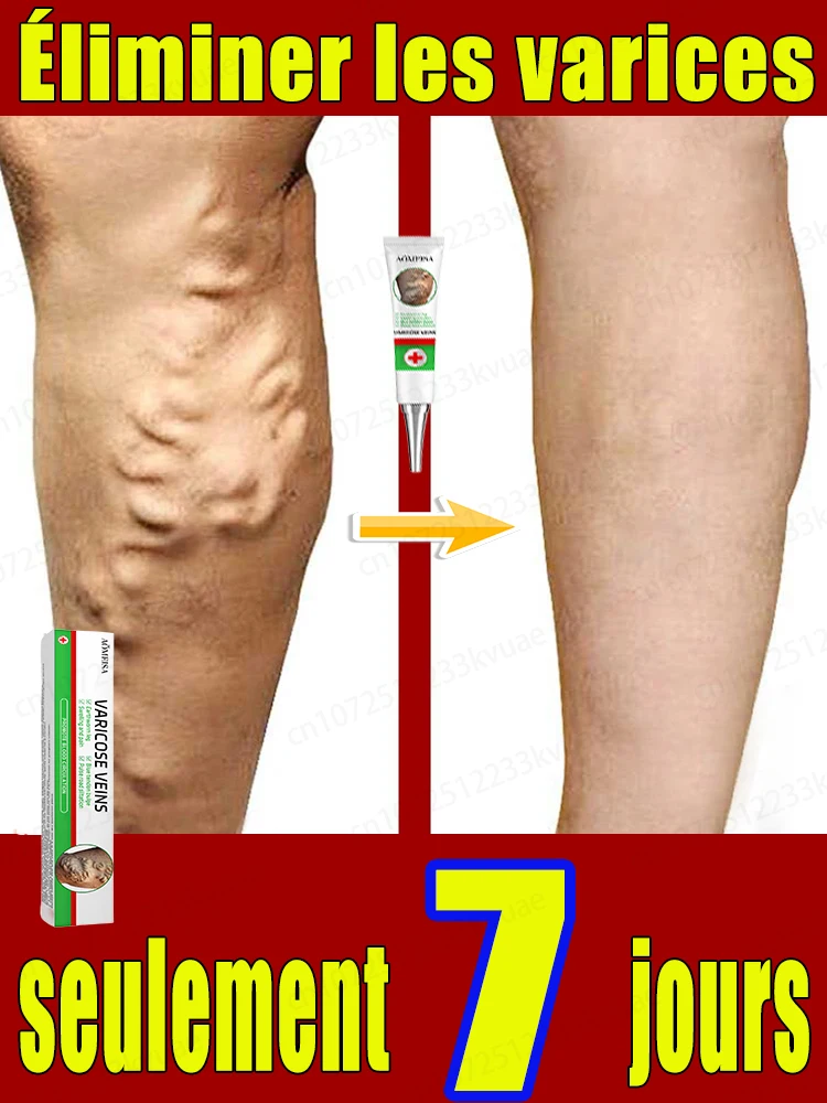 Pommade-contre-les-varices-r-pare-les-varices-et-la-vascularite-en-7 ...