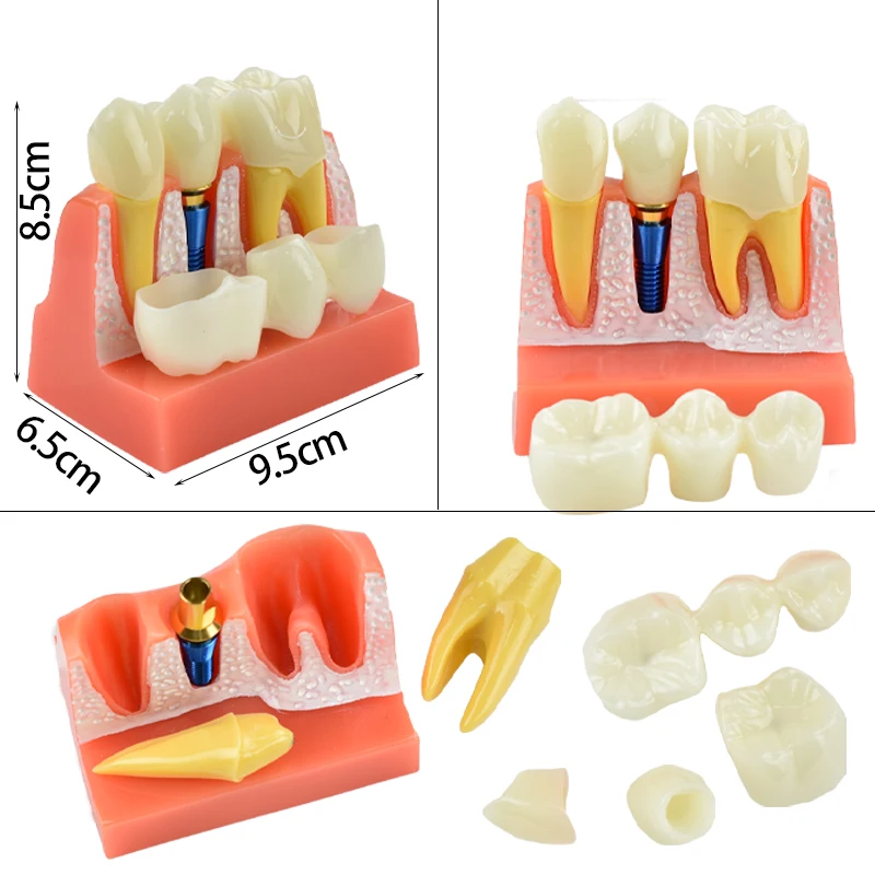 Dental-Teach-4-Times-Implant-Analysis-Crown-Bridge-Removable-Model ...