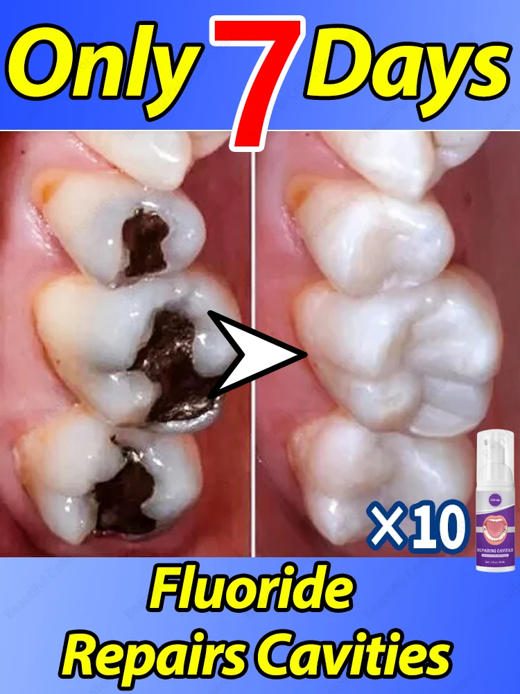 Tooth-decay-Repair-Repairing-Cavities-Anti-Protecting-Caries.jpg