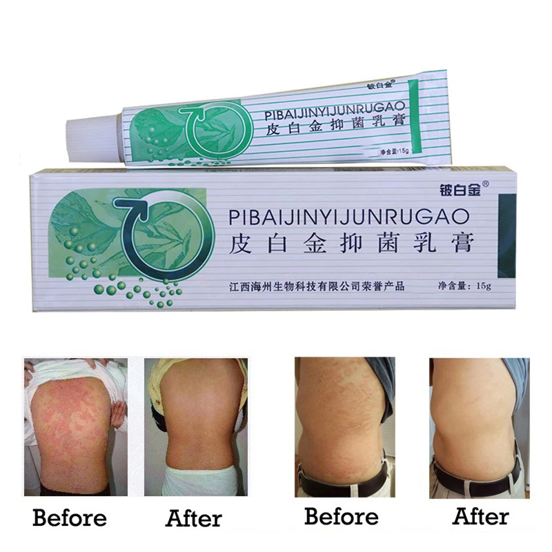 Natural Herbal Skin Care Antipruritic Body Psoriasis Cream Dermatitis ...