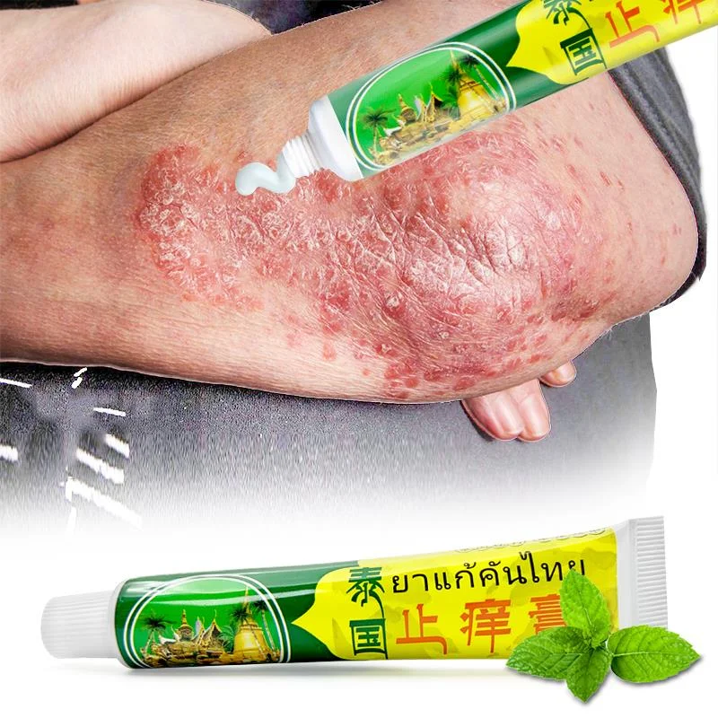 4pcs-Thailand-Skin-Treatment-Ointment-Psoriasis-Cream-Anti-itch-Repair ...