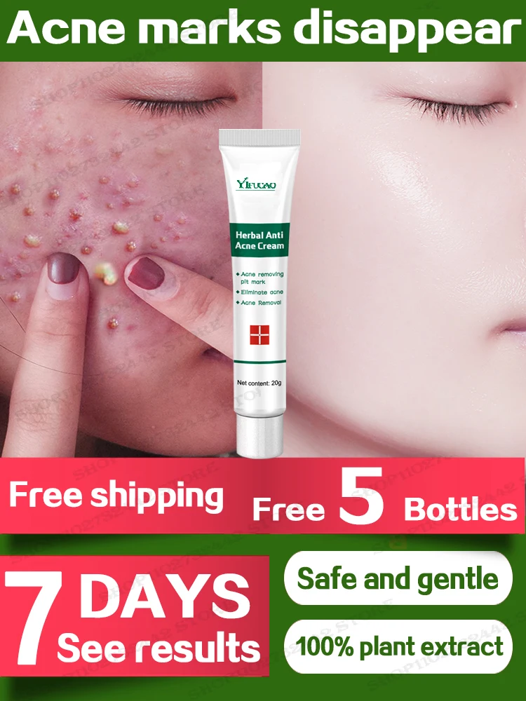 Herbal-Acne-Cream-To-Remove-Acne-And-Eliminate-Acne-Marks-Treatment ...