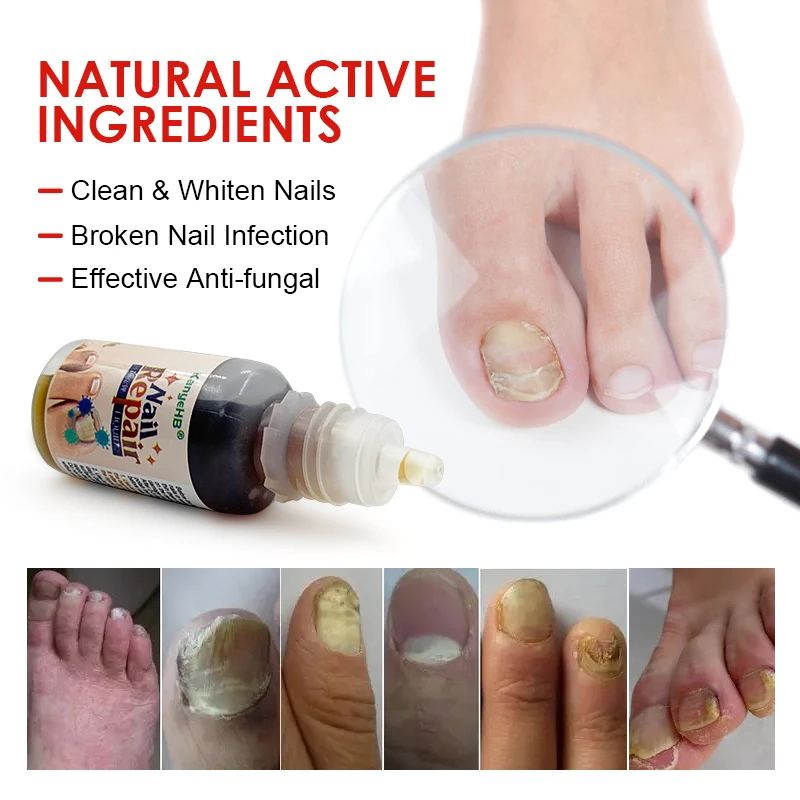 3Pcs Fungus Nails Treatment Liquid For Fingernails Toenails Repair ...