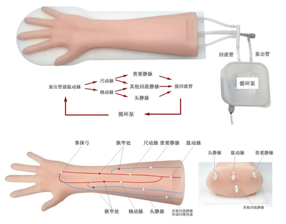 B ultrasound arteriovenous fistula anastomosis Mouth Stenosis Balloon ...