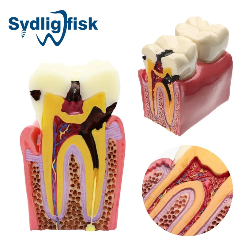 Dental-Teeth-Model-6-Times-Caries-Comparative-Study-Denture-Tooth ...