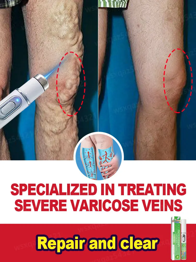 Laser-therapy-can-improve-medium-intensity-varicose-veins-effectively ...