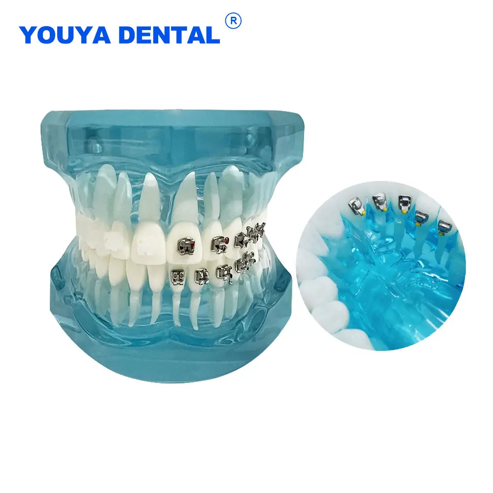 Classification of Crowding in Orthodontics: How This Dental Teaching ...