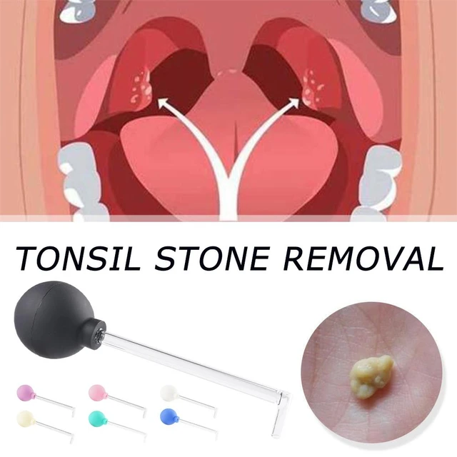 Tonsillectomy Tool