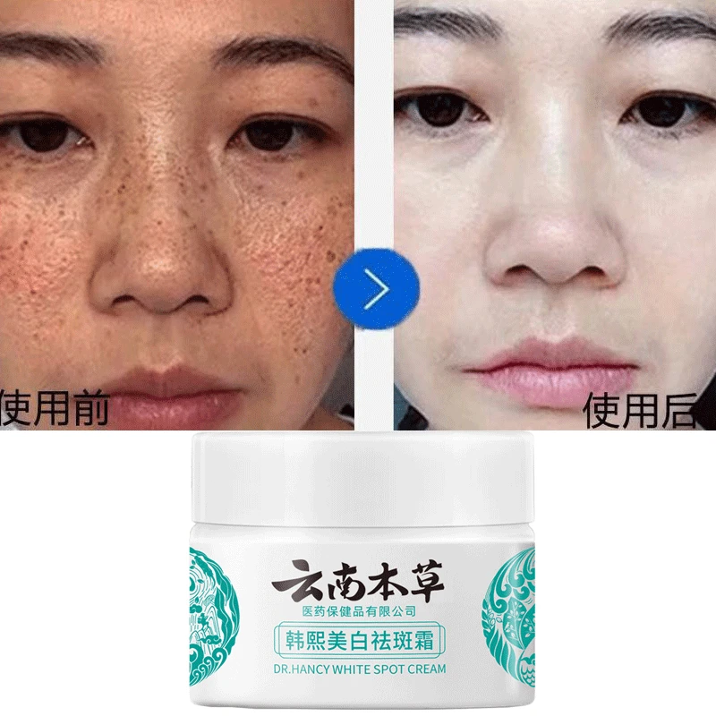 {spot} Yunnan Herbal Whitening Freckle Removal Cream Spot Fading Fade ...