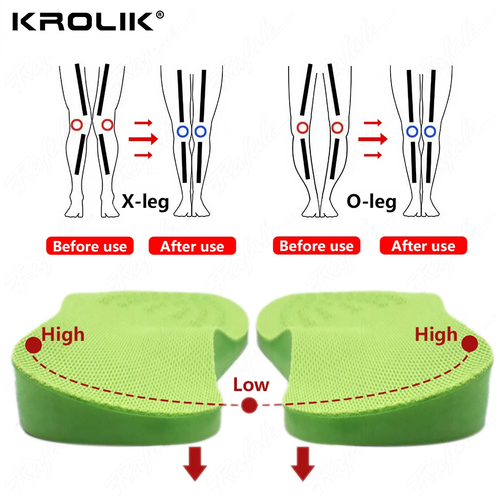 O-X-Leg-Orthopedic-Insoles-Arch-Support-Insole-Corrigibil-Bow-Legs ...