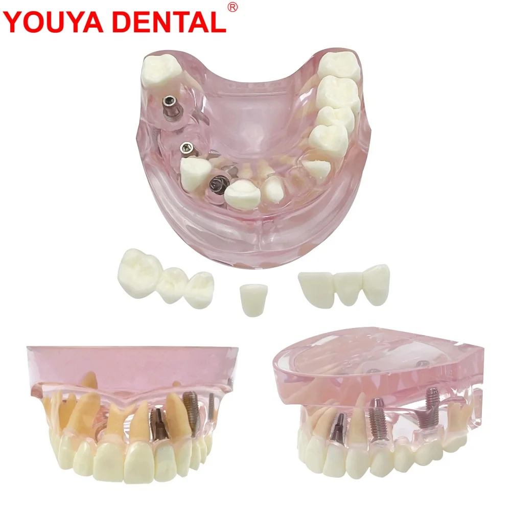 3-Implants-Maxillary-Teeth-Implant-Model-Upper-Jaw-Restoration-Dental ...