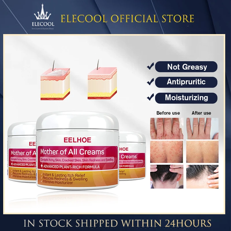 30/50g Tinea Cruris Scrotum Itch Dermatitis Rash Eczema Cream Psoriasis ...