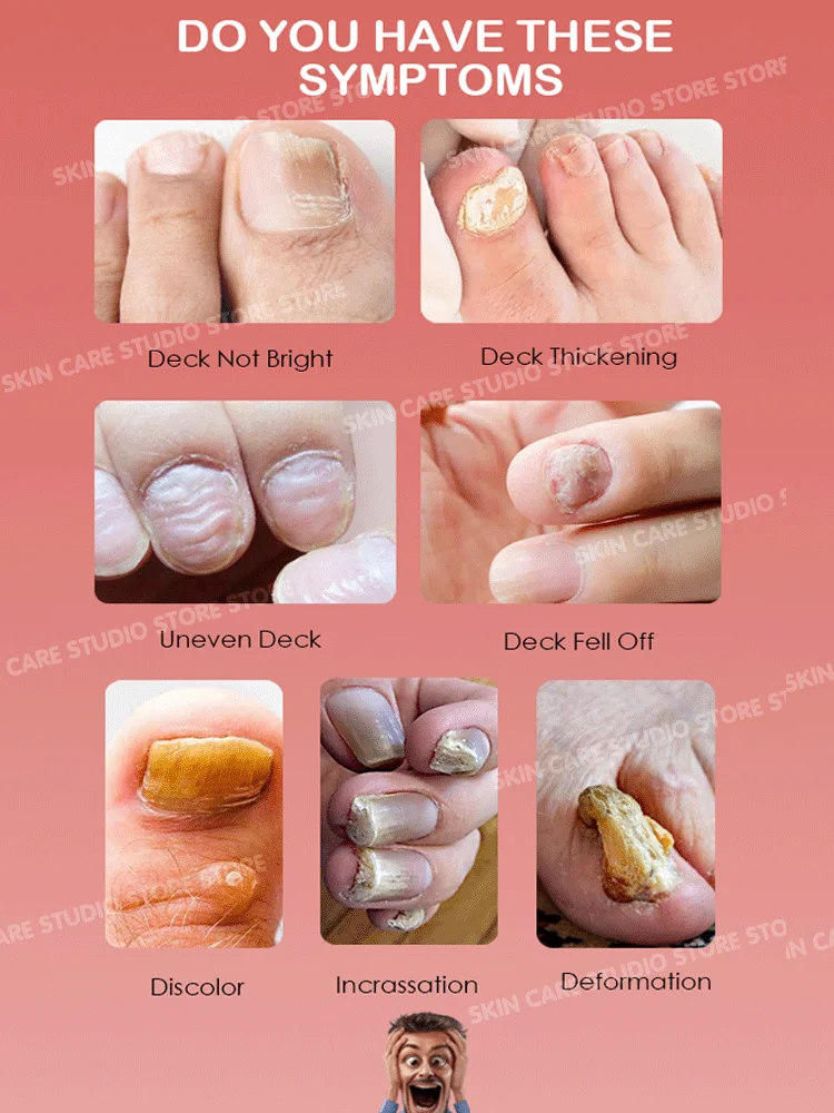Ringworm On Nails