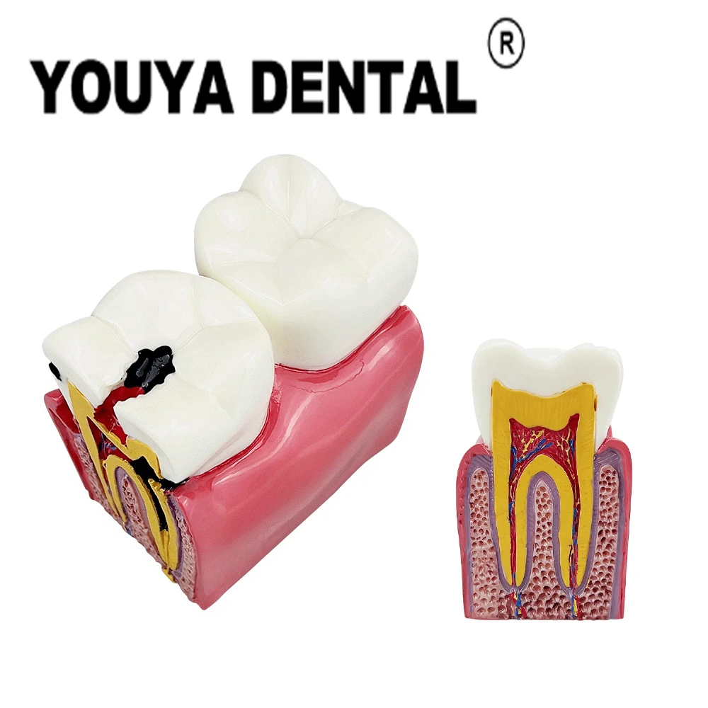 6 Times Dental Caries Comparison Models Anatomy Molar Model For Dentist ...