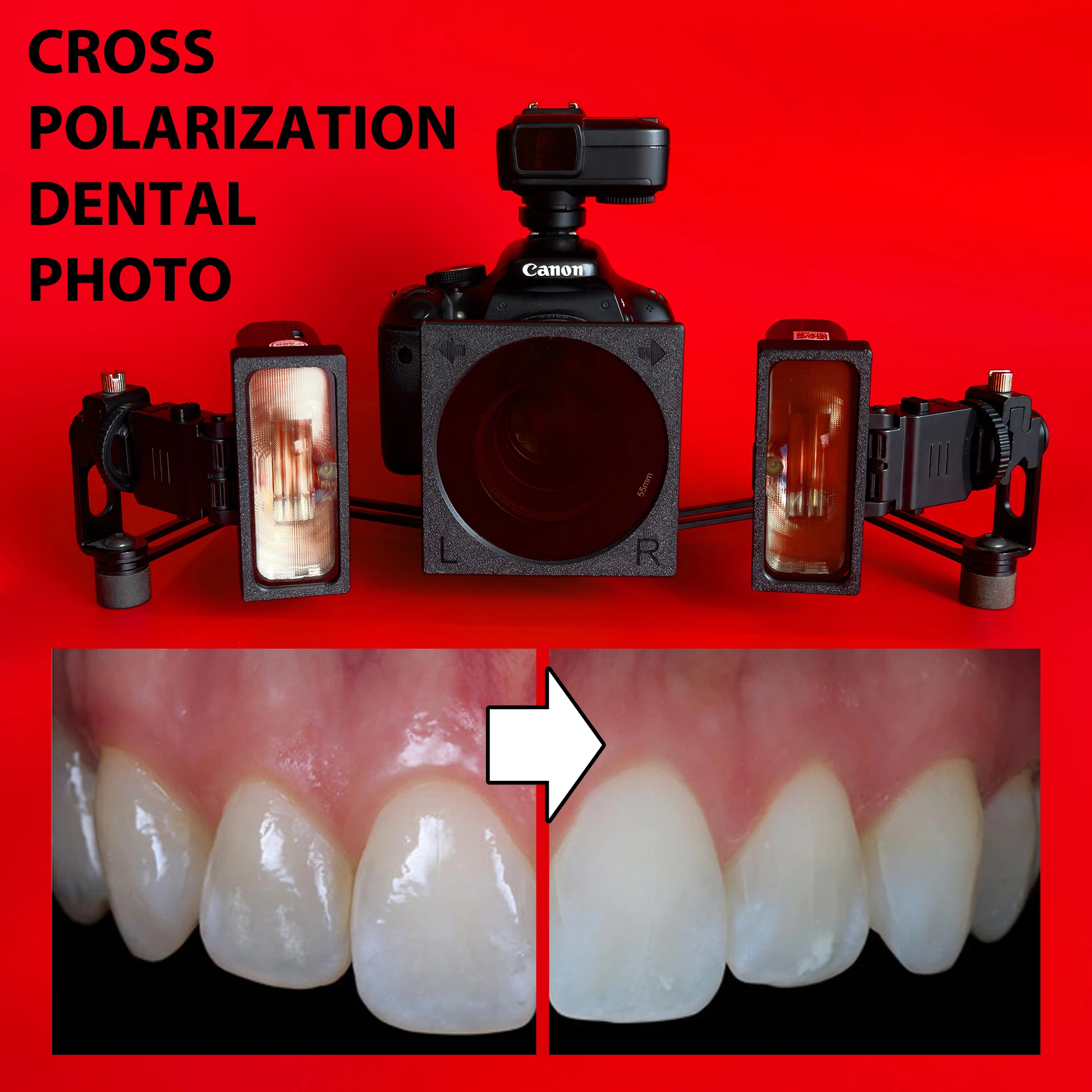 Cross-Polarization-Set-For-Dental-Oral-Photography-Godox-MF12-Camera ...
