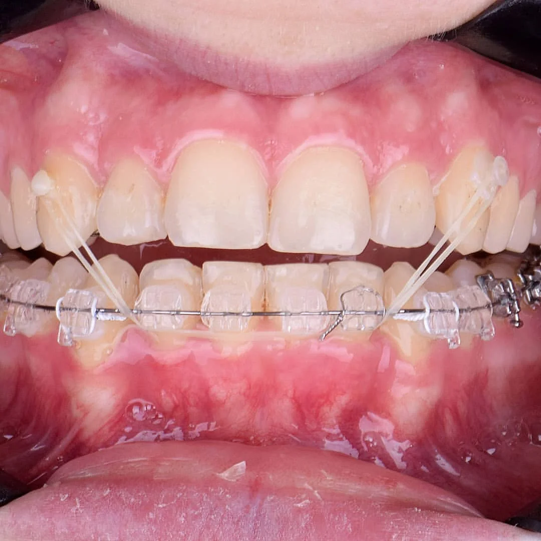 Botones Linguales Transparentes AZDENT Botón Lingual Ortopédico Dental ...