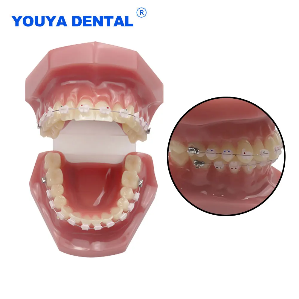 Full-Ceramic-Braces-Orthodontic-Models-Dental-Model-With-Braces-Dental ...