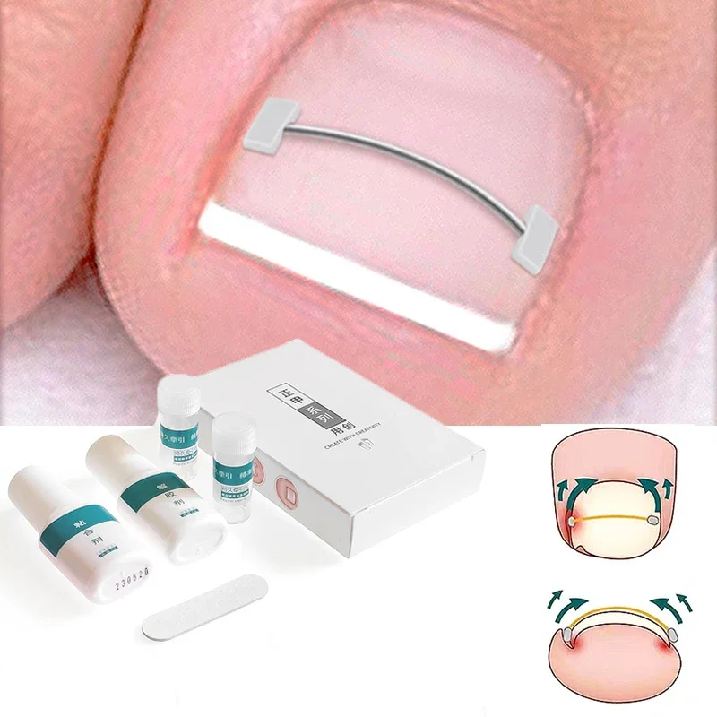 Ingrown-Toenail-Corre-o-Ferramentas-Tratamento-Profissional-Recuperar ...