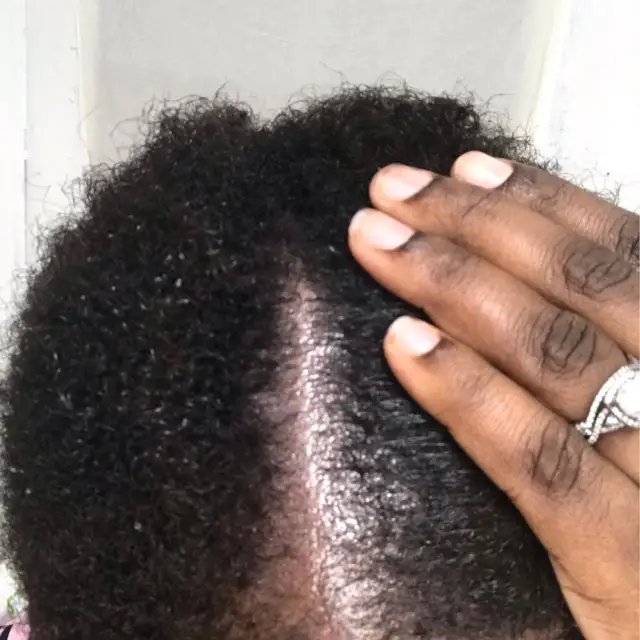 Psoriasis Scalp African American