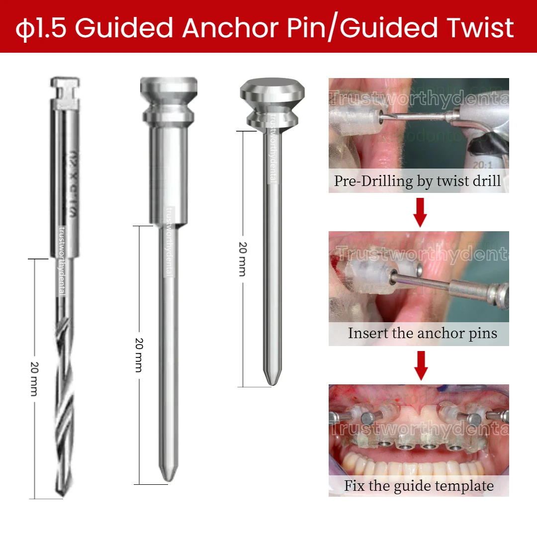 Φ1,5x20 Dental Guided Anchor Pin Guided Spiralbohrer Long& Short Shaft ...