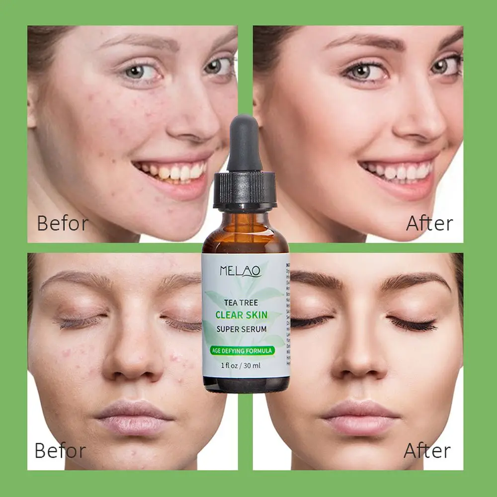 Tea Tree Oil Acne Before And After
