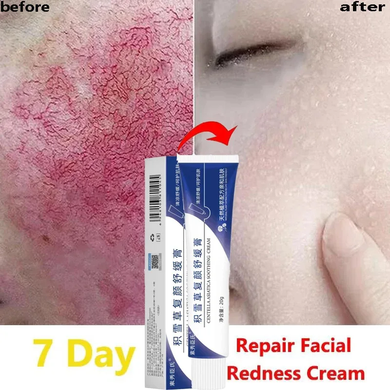 Instant-Facial-Redness-Repair-Cream-Effective-Soothing-Red-Blood ...