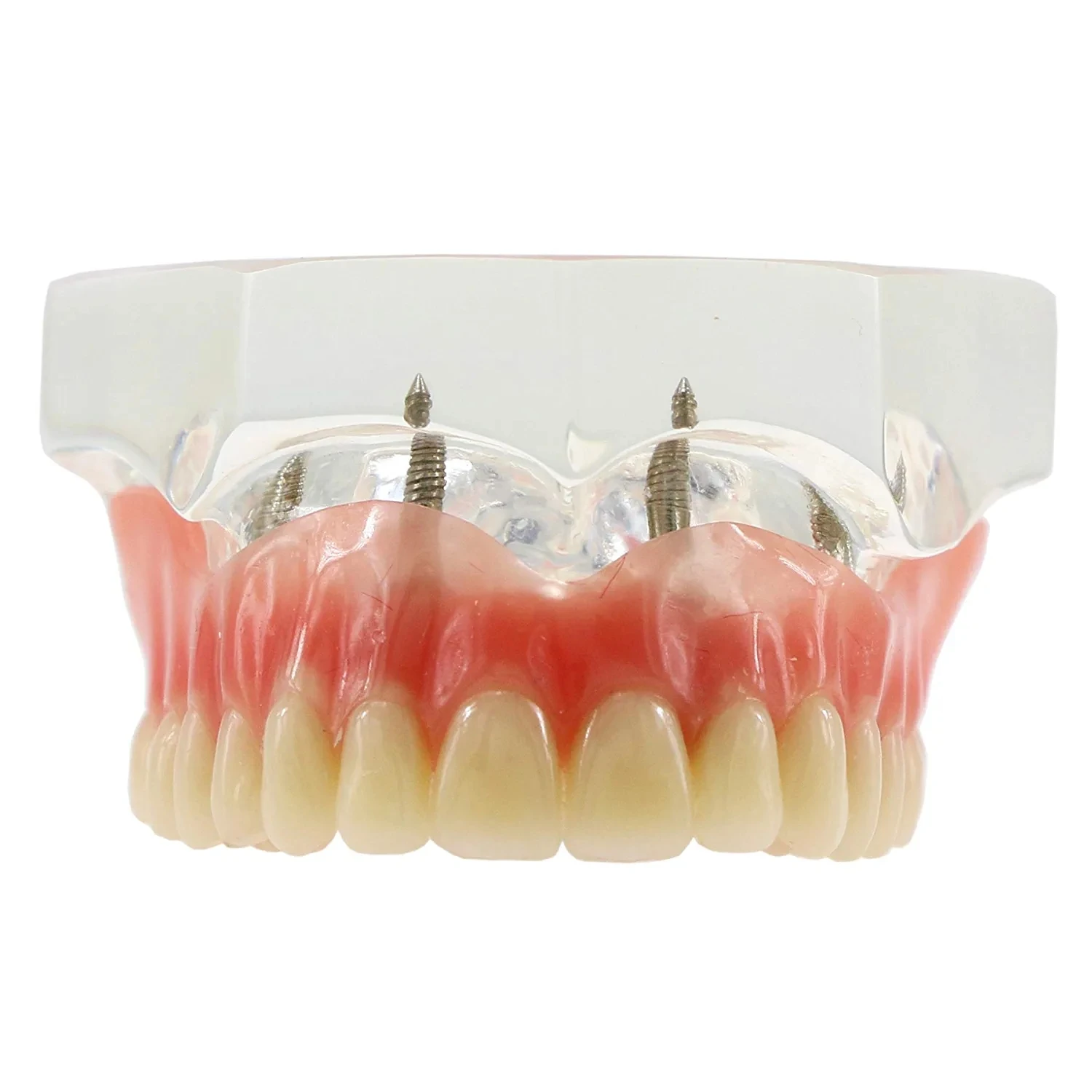 Dental-Upper-Implants-Model-Overdenture-with-4-Superior-Teeth-Demo ...