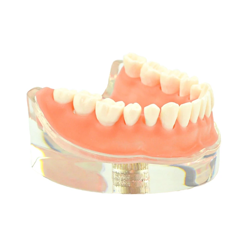Dental-Implant-Restoration-Teeth-Model-Removable-Bridge-Denture-Demo ...