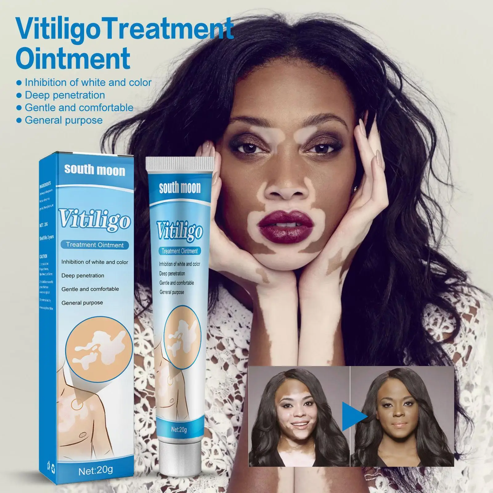 20g Herbal Extract Vitiligo Ointment Remove Ringworm White Removal ...