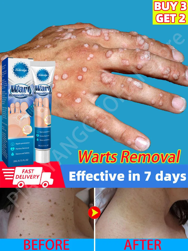 Filiform Wart Removal