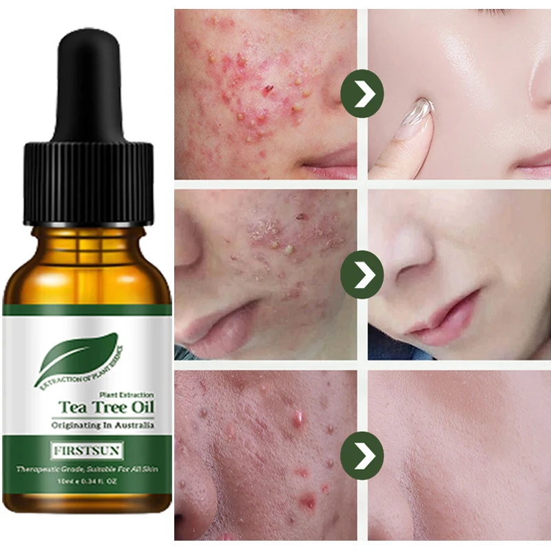 Tea Tree Oil Acne Scars