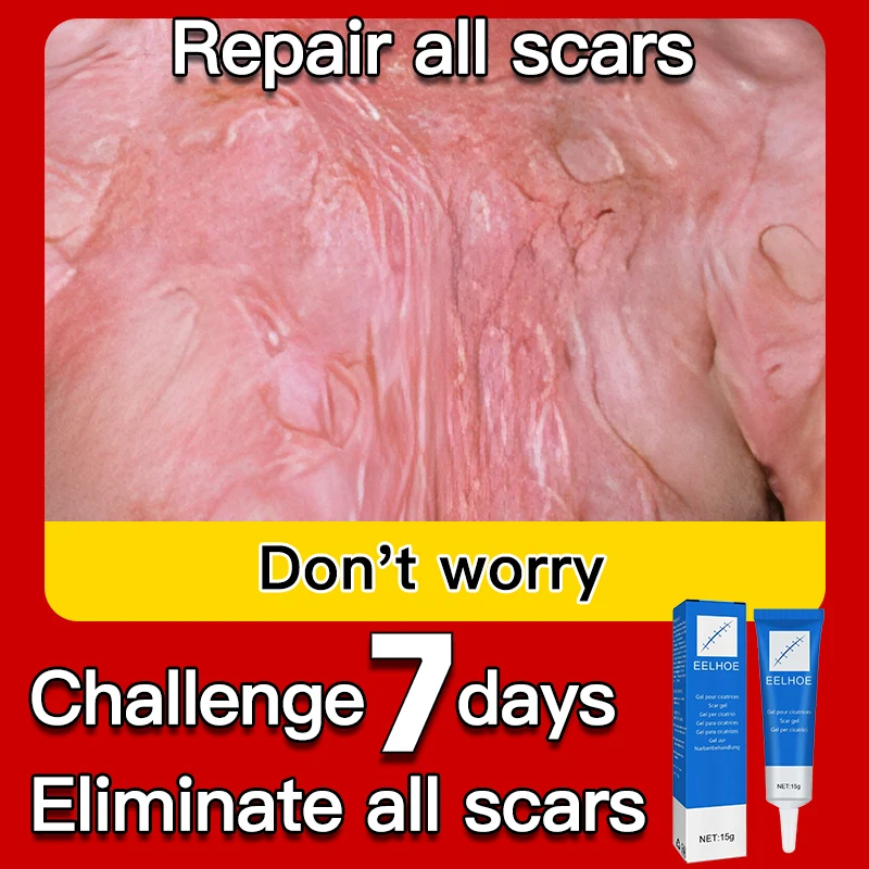 Scar Remoção Creme Gel, Remover Acne Spots, Estrias, Queimar Cirurgia ...