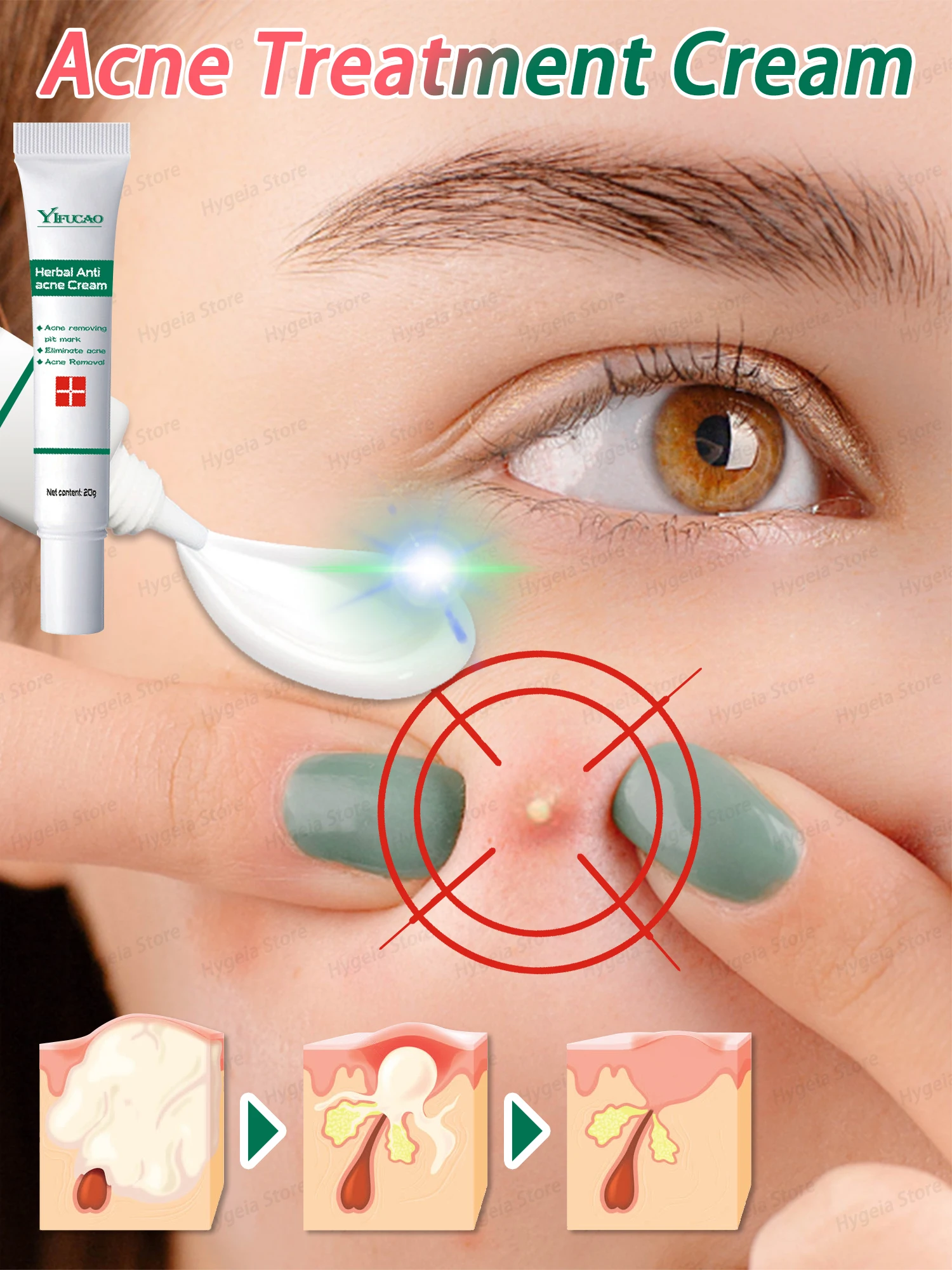 Salicylic-Acid-Acne-Cream-Face-Care-Ointment-Remove-Acne-Eliminate-Acne ...