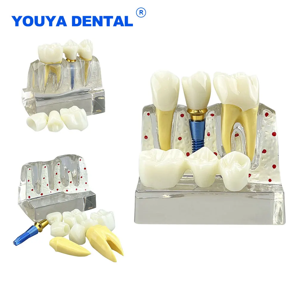Dental-Implant-Transparent-4-Times-Teeth-Model-Removable-Analysis-Crown ...