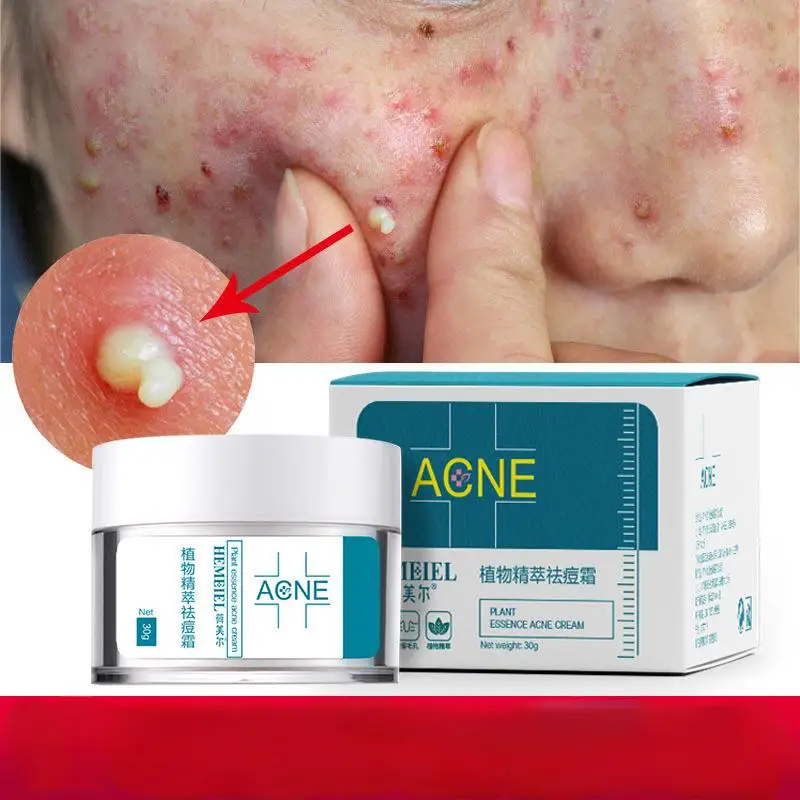 Acne removing cream regulates acne muscles, removes acne, desalinates ...
