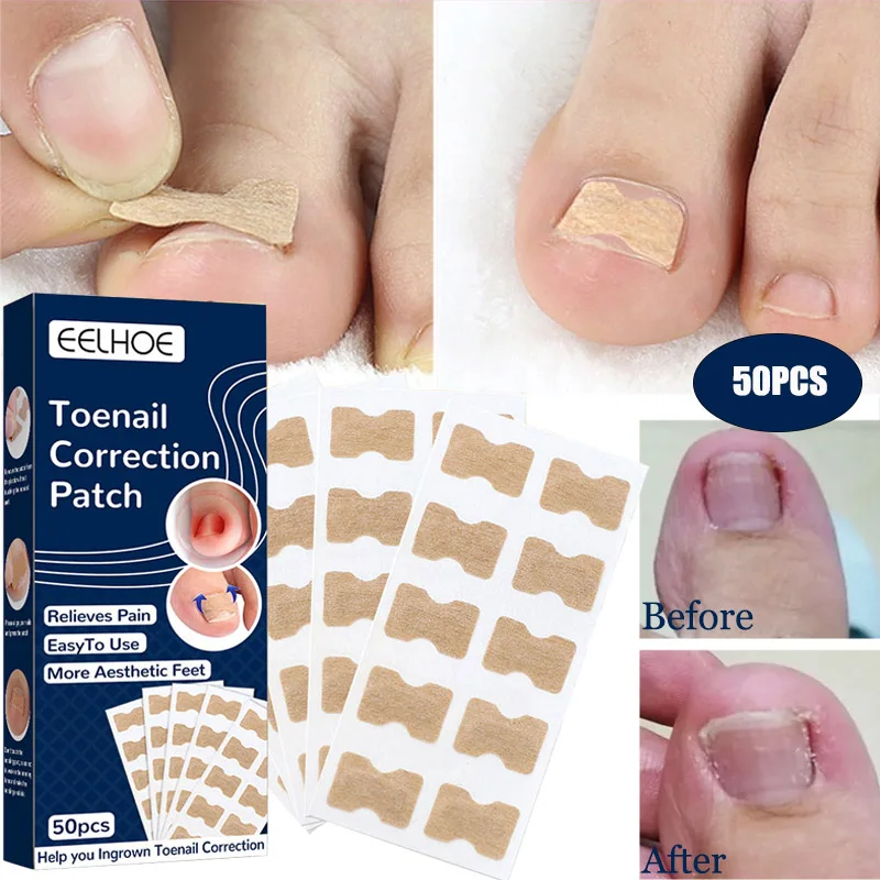 Waterproof-Nail-Correction-Stickers-50PCS-Ingrown-Toenail-Corrector ...
