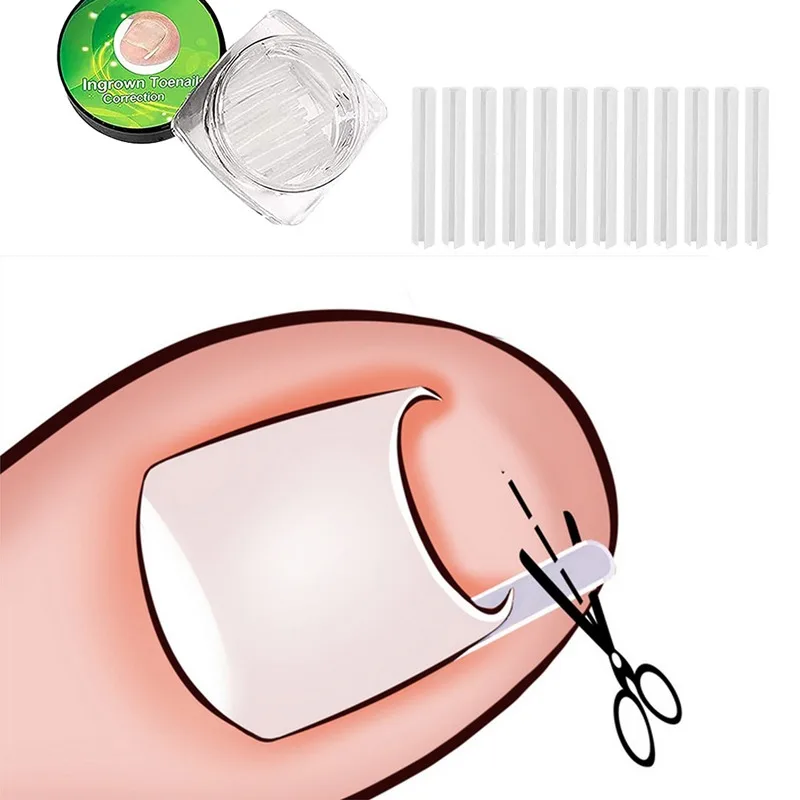 10pcs Ingrown Toenail Correction Tool Ingrown Toe Nail Treatment ...