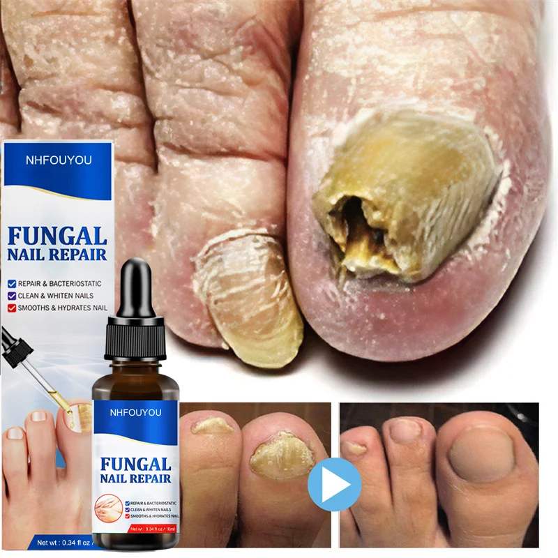 Fungal-Nail-Treatment-Oil-Foot-Repair-Essence-Toe-Nail-Fungus-Removal ...